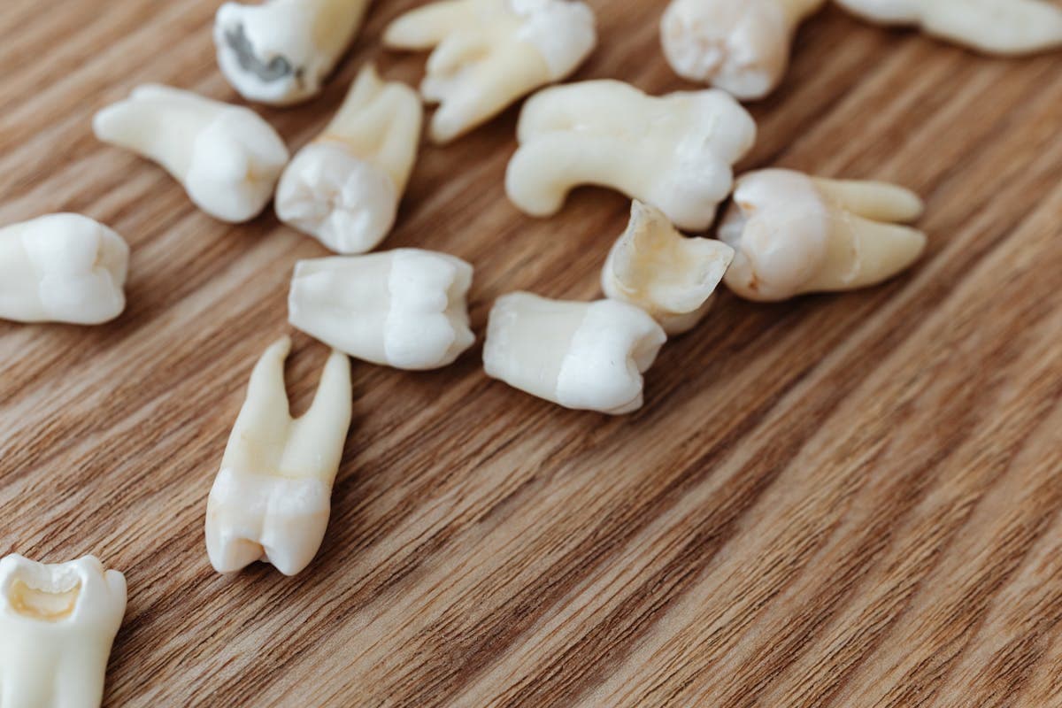 What Causes Black Teeth in Adults | Dental Inbound